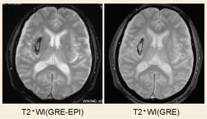 磁化率強調画像と無症候性微小脳出血 | MRIfan.net