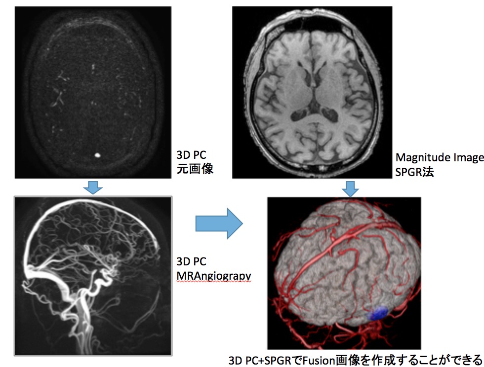 Inhance 3D Velocityを用いた頭部造影3DT1強調画像 | MRIfan.net