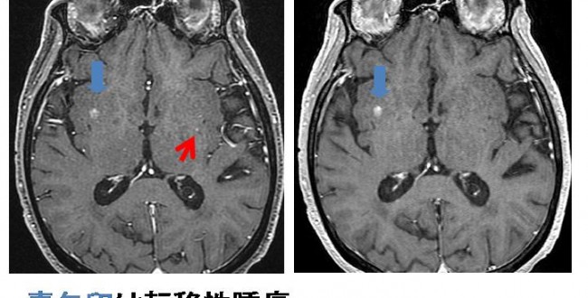 Inhance 3D Velocityを用いた頭部造影3DT1強調画像 | MRIfan.net