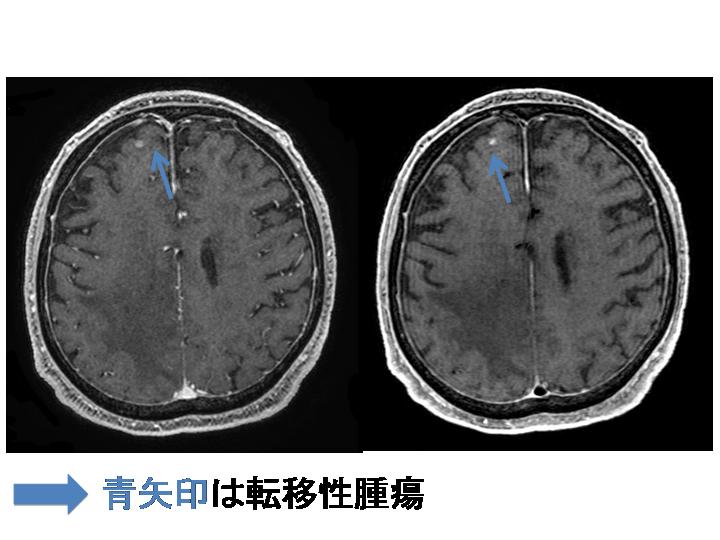 Inhance 3D Velocityを用いた頭部造影3DT1強調画像 | MRIfan.net