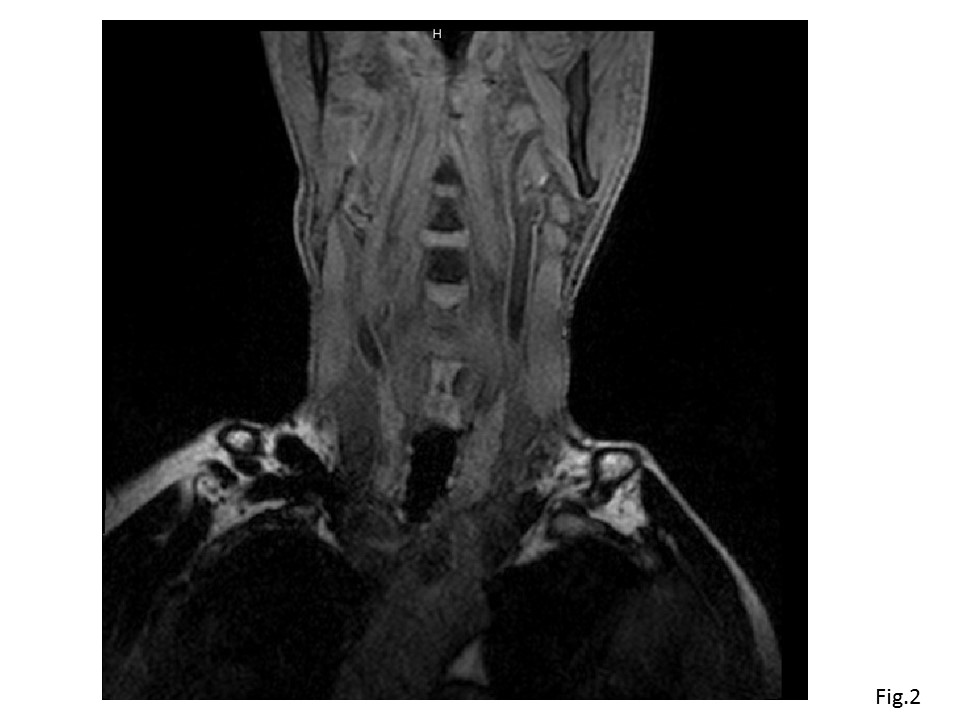 3.0T-MRIにおけるMP-RAGEを用いたMR Direct Thrombus Imagingの落とし穴 | MRIfan.net