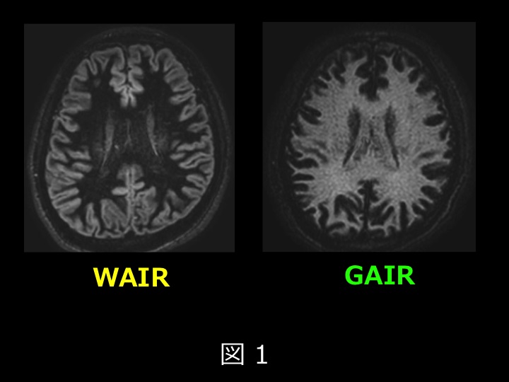 Double IR法について ～キモは2つのTI～ | MRIfan.net