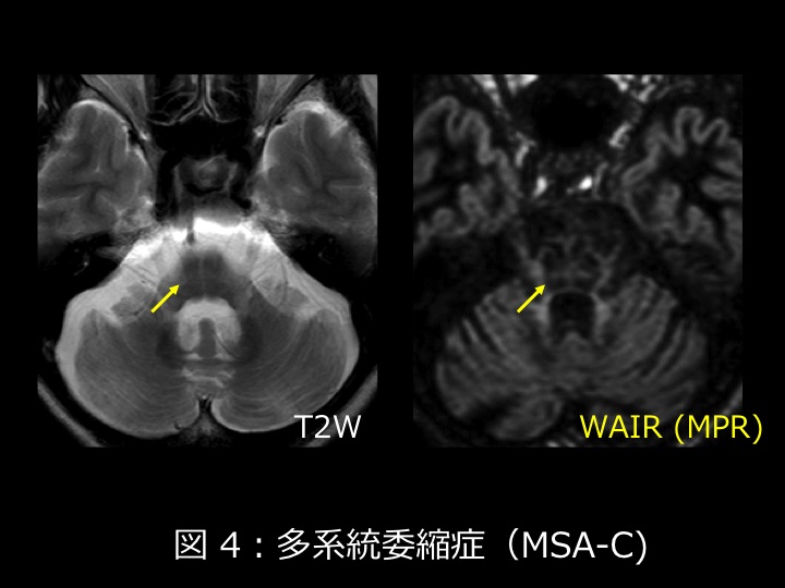 Double IR法について ～キモは2つのTI～ | MRIfan.net