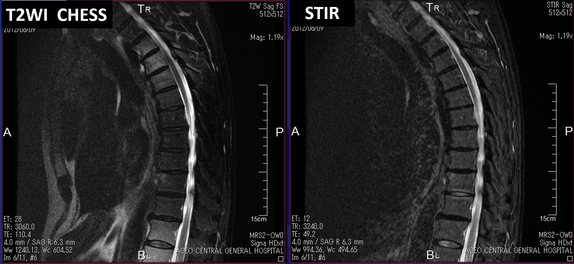 胸椎でもCHESS法を使ってみませんか？ | MRIfan.net