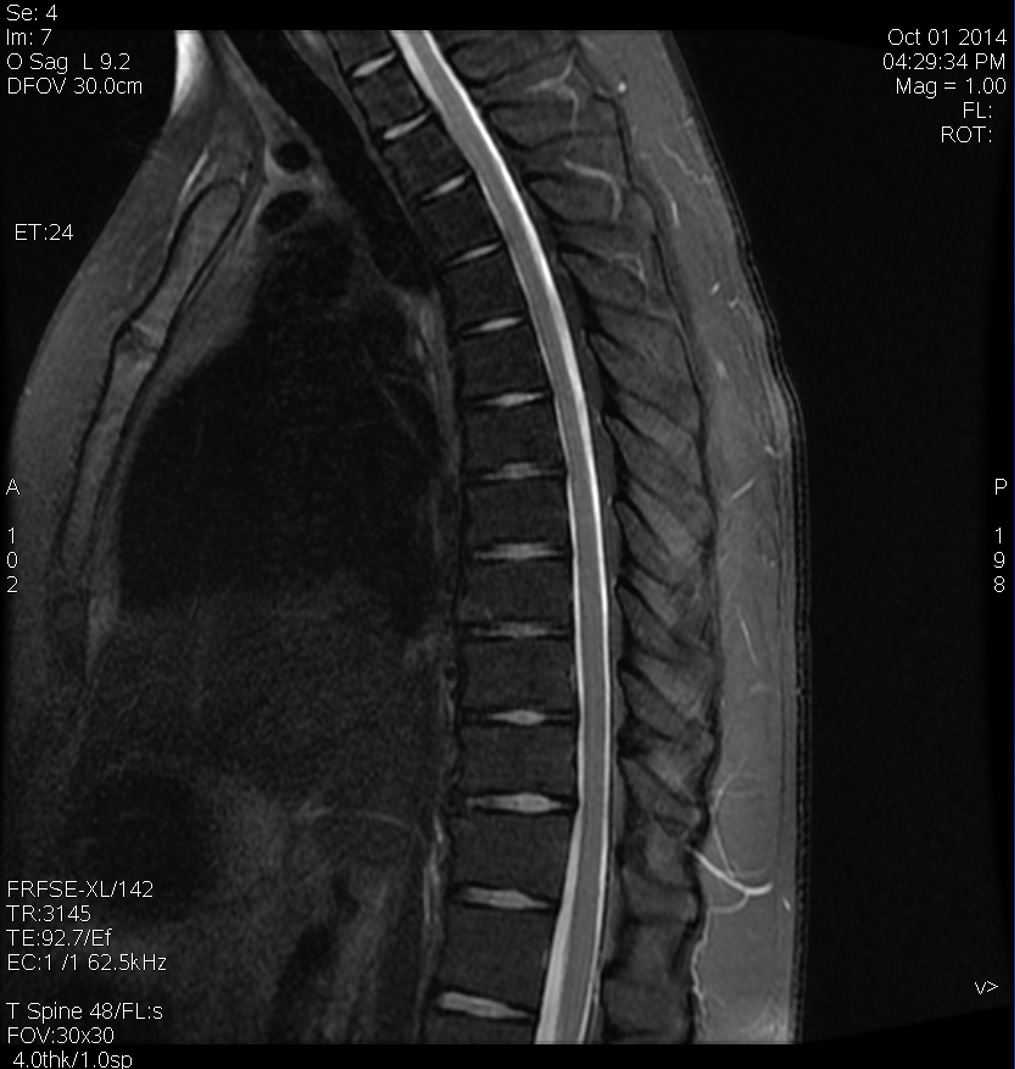 胸椎でもCHESS法を使ってみませんか？ | MRIfan.net