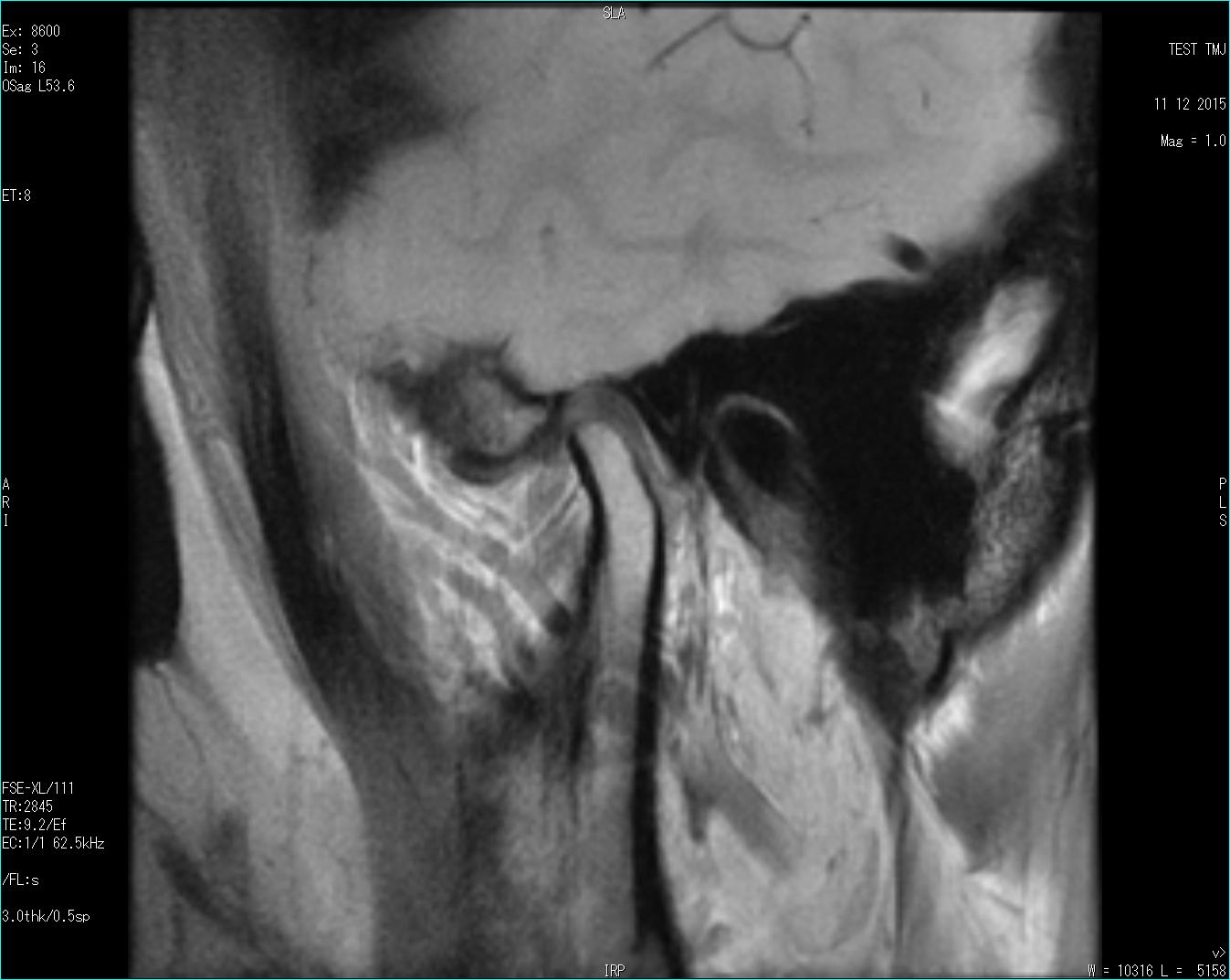 固定観念を変えよう！！顎関節撮影編 〜表在コイルの利用 | MRIfan.net