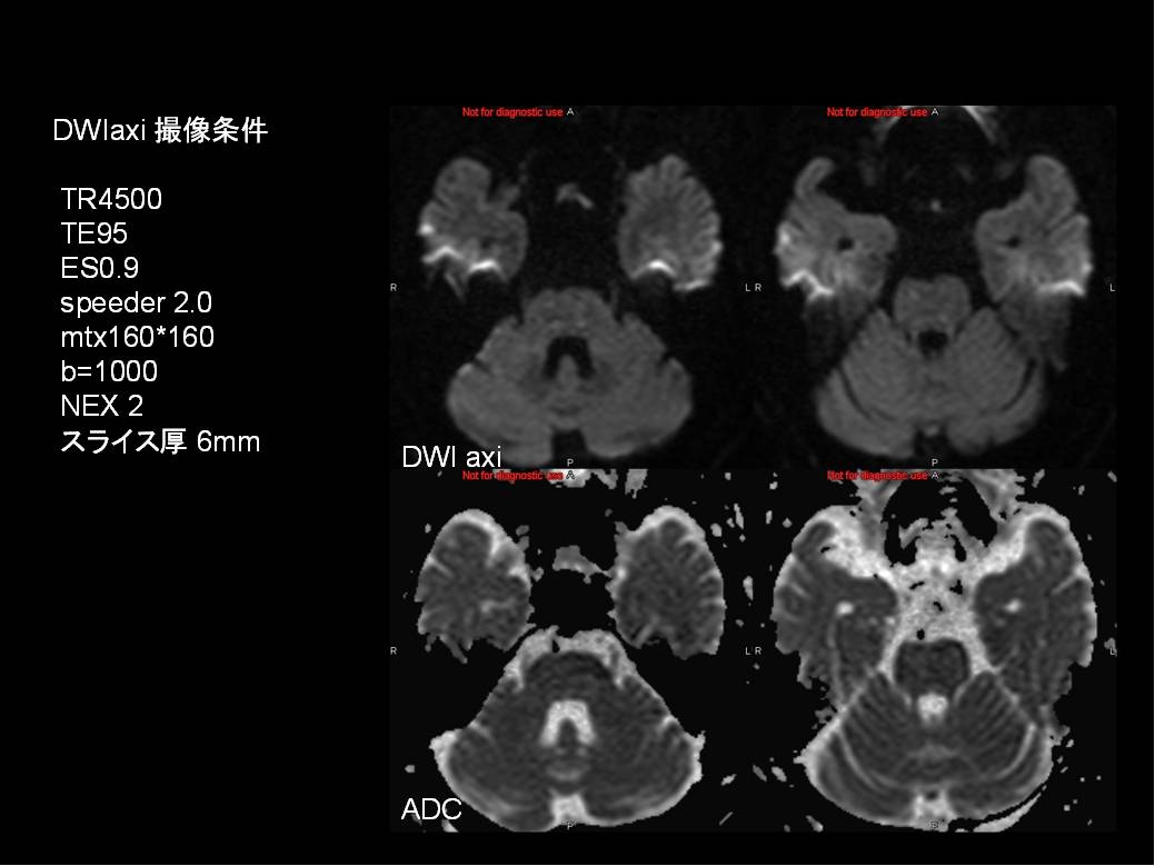 時には有用、頭部Direct Coronal DWI！ | MRIfan.net
