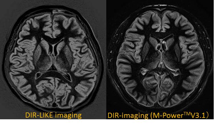 当院でもできる！DIR (like imaging) | MRIfan.net