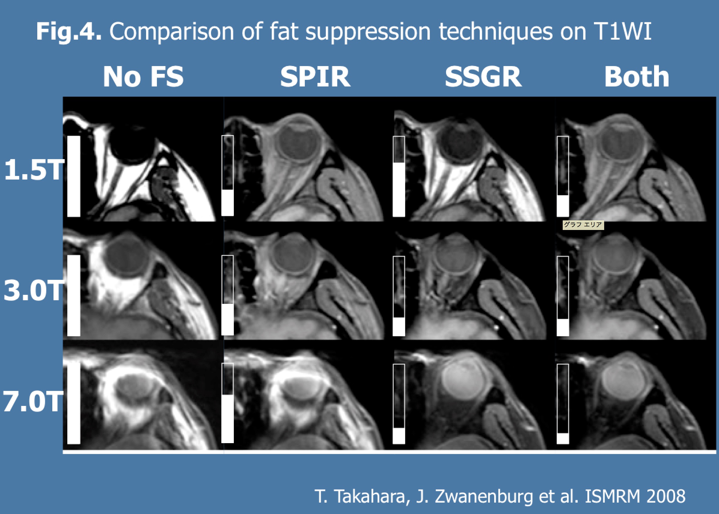 DWIにおけるSSGRとCHESS, STIRについて（補足説明） | MRIfan.net