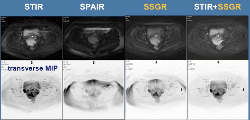 DWIにおけるSSGRとCHESS, STIRについて（補足説明） | MRIfan.net