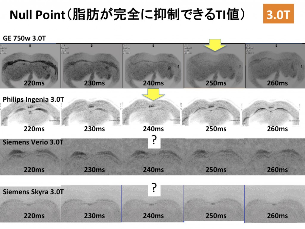 DWIにおけるSSGRとCHESS, STIRについて（補足説明） | MRIfan.net