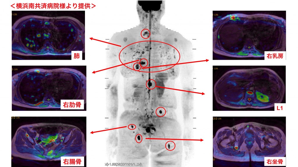 GE装置でのDWIBS撮像方法 〜標準化に向けて〜 | MRIfan.net