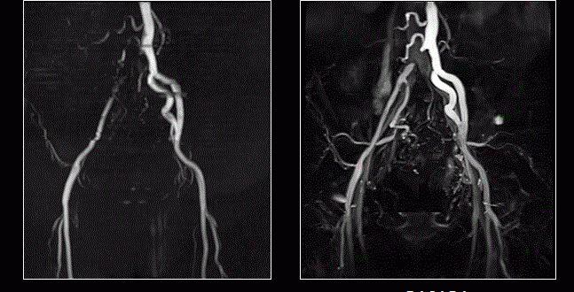 NATIVE-SPACEを応用した新しいMRAの手法!?「BASARA（バサラ）」 | MRIfan.net