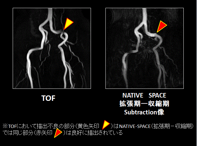 NATIVE-SPACEを応用した新しいMRAの手法!?「BASARA（バサラ）」 | MRIfan.net