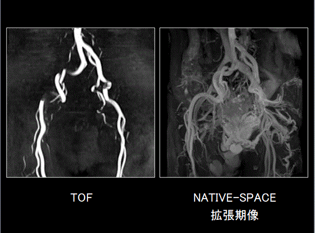 NATIVE-SPACEを応用した新しいMRAの手法!?「BASARA（バサラ）」 | MRIfan.net