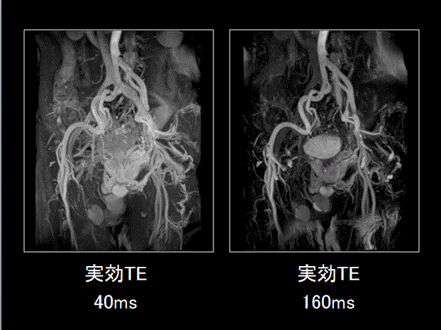 NATIVE-SPACEを応用した新しいMRAの手法!?「BASARA（バサラ）」 | MRIfan.net