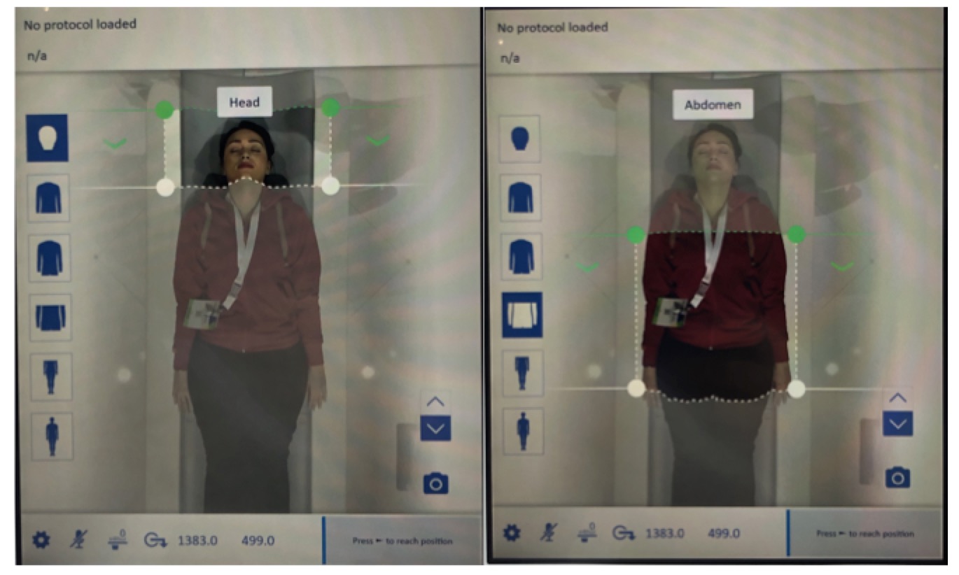 RSNA2018 Report (4) Siemens CT (Force 3D Camera) & AI | MRIfan.net
