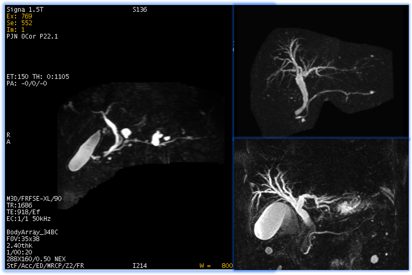 Breath-hold 3D MRCP 決定版!! | MRIfan.net