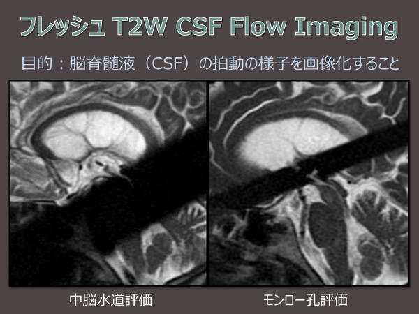 SIGNA甲子園2021 銀賞授賞演題「フレッシュ T2W CSF Flow Imaging」 | MRIfan.net