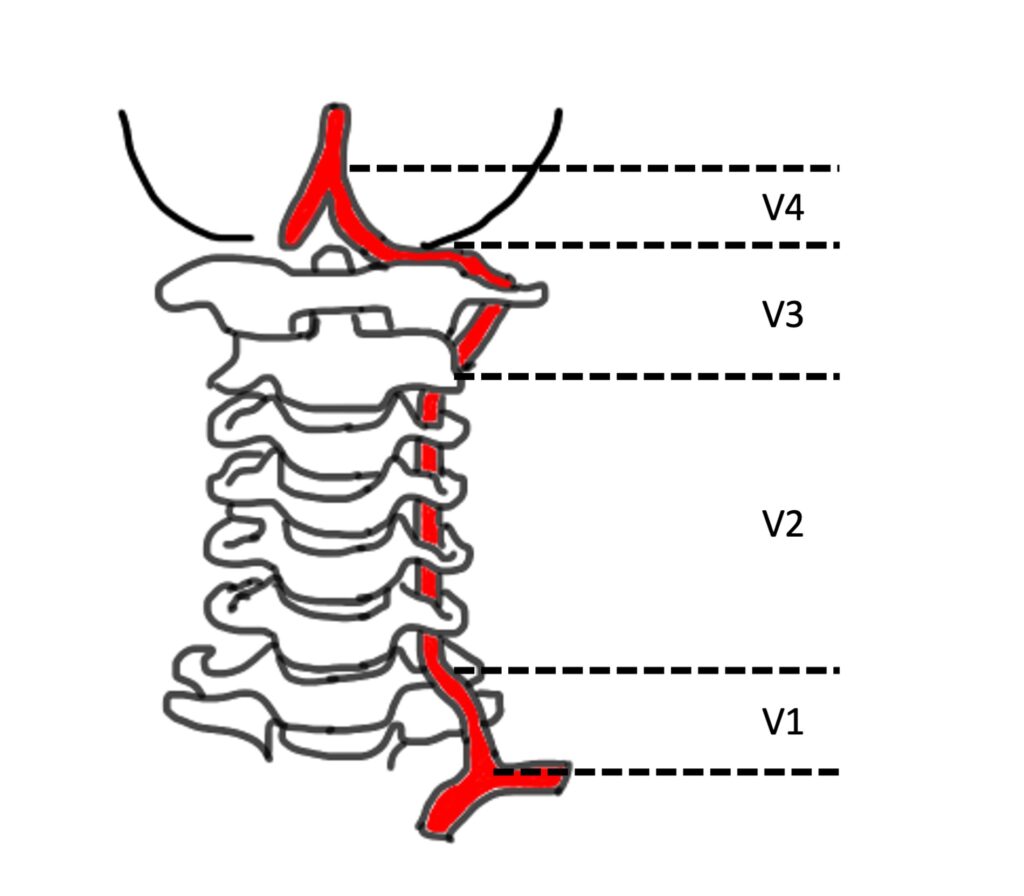T2-Reversed BPASによる椎骨動脈描出能の改善 | MRIfan.net