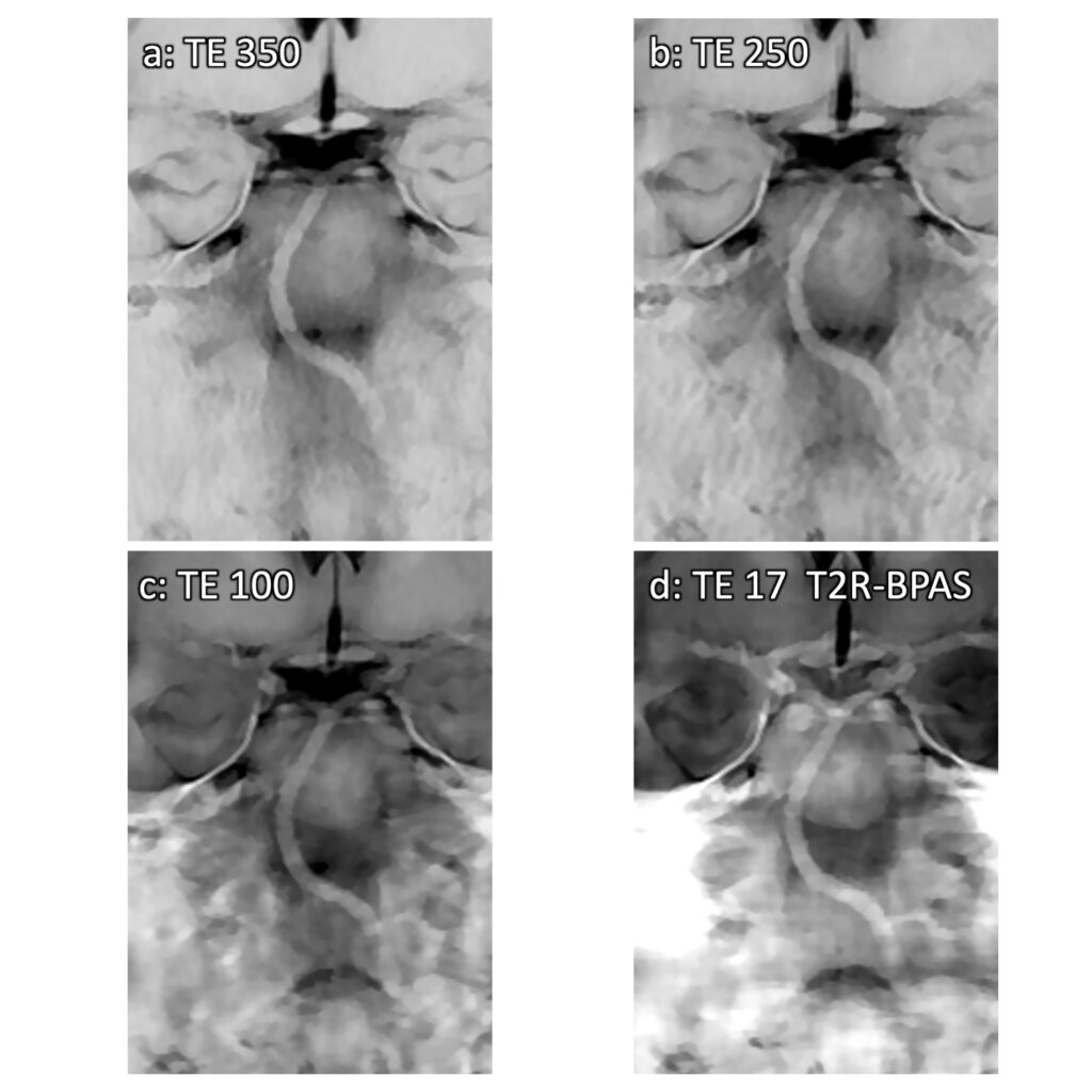 T2-Reversed BPASによる椎骨動脈描出能の改善 | MRIfan.net