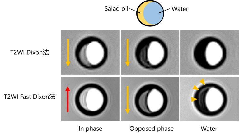 Fast Dixon法の特徴と注意点 | MRIfan.net