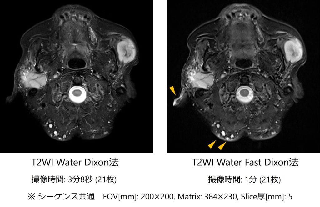 Fast Dixon法の特徴と注意点 | MRIfan.net