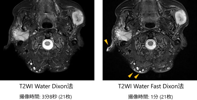 Fast Dixon法の特徴と注意点 | MRIfan.net