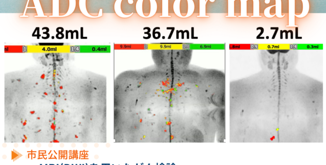 第17回BodyDWI研究会 ADC colormap特集（2024/1/21日） | MRIfan.net