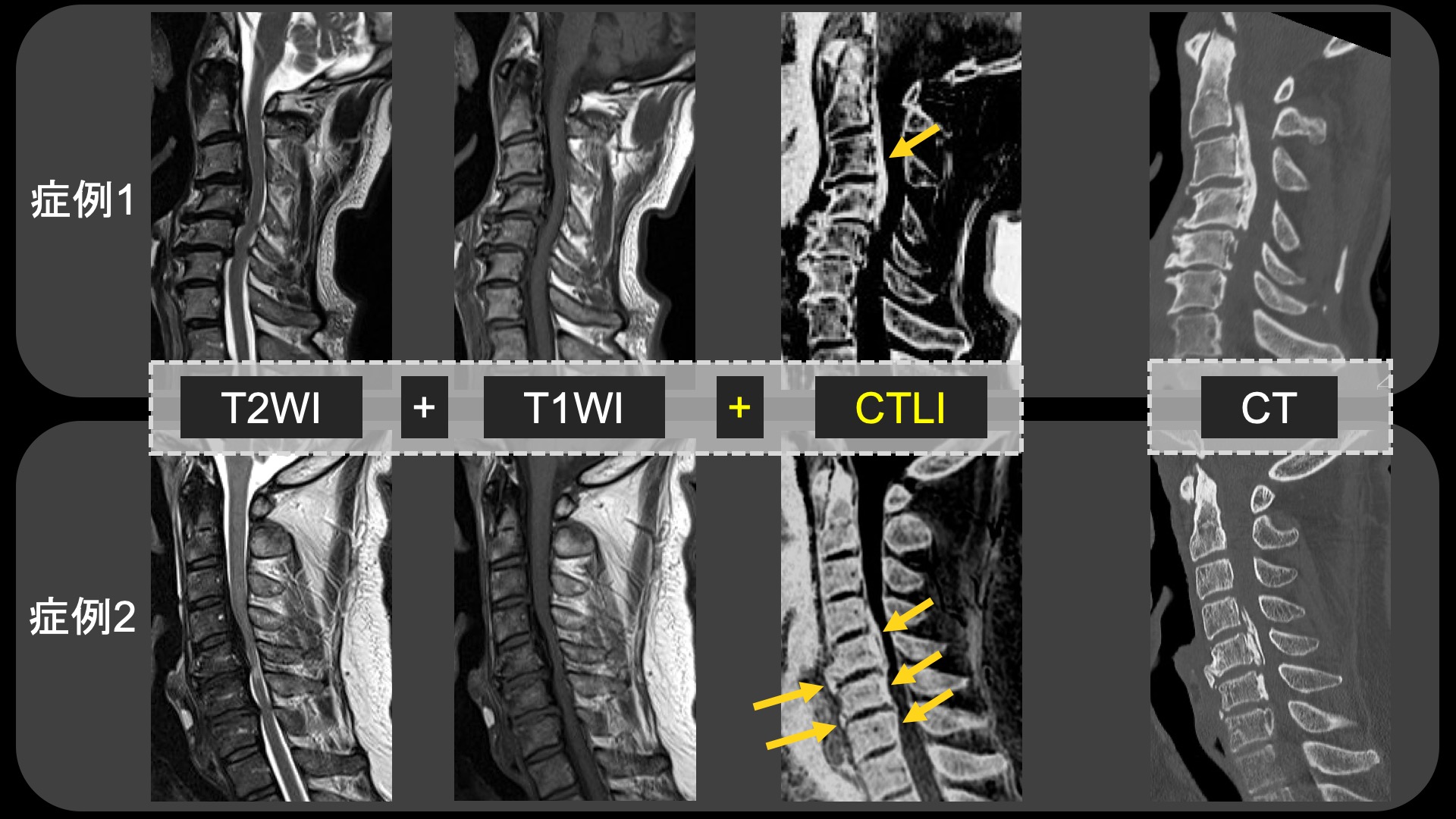 誰でも撮れる？『頚椎CTLI』 | MRIfan.net