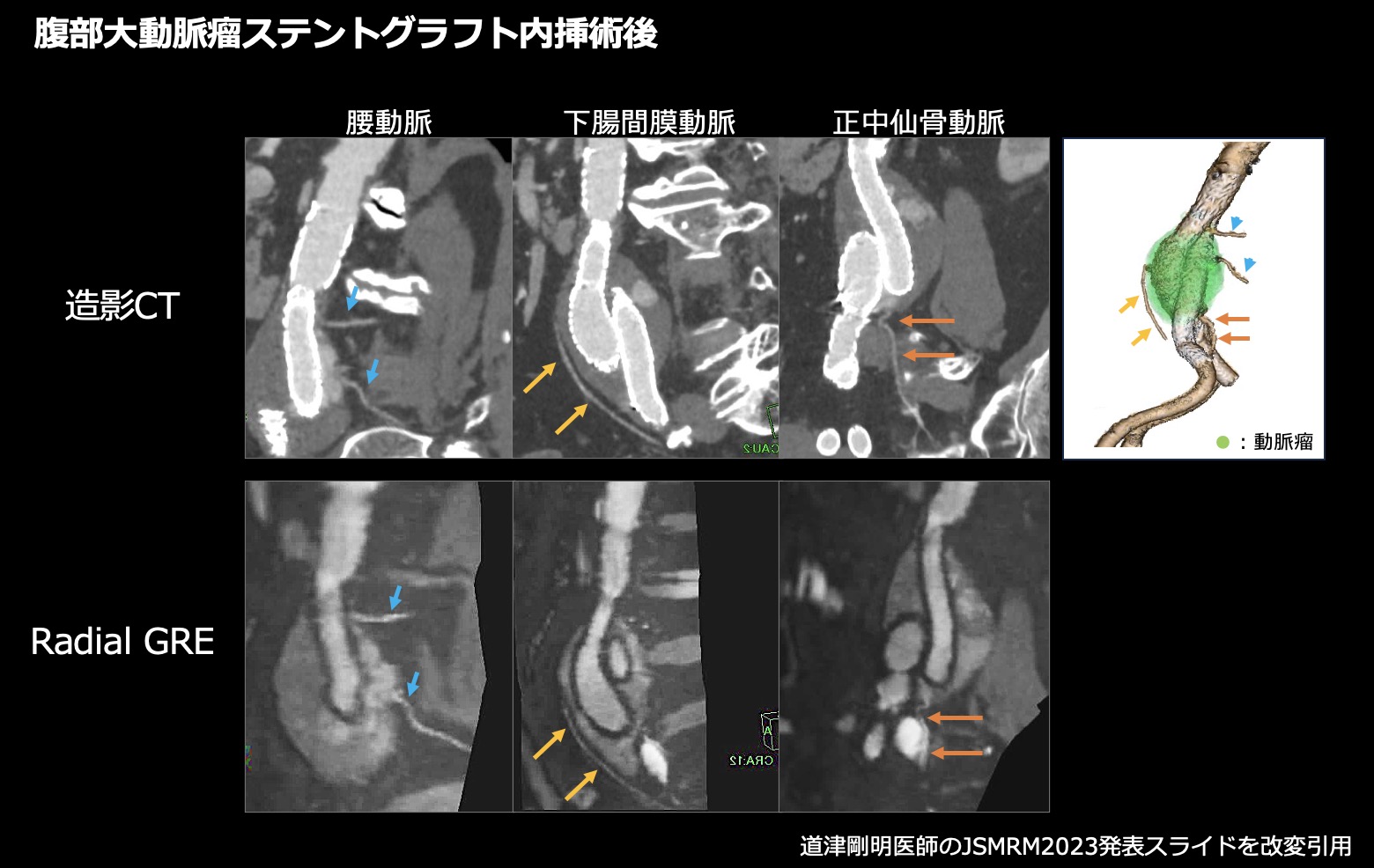 自由呼吸・非同期・非造影MRA『Radial GRE』 | MRIfan.net