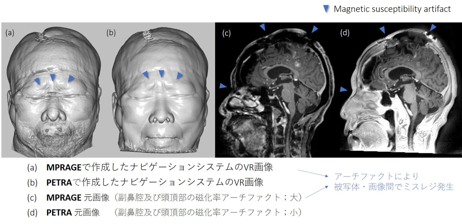 脳腫瘍術前検査はultra-short TEシーケンス（PETRA）におまかせ | MRIfan.net