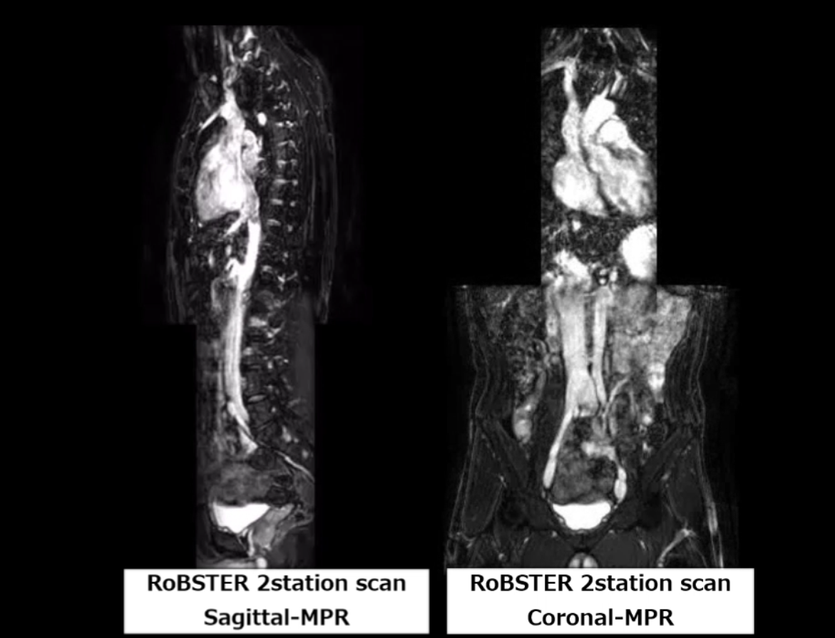 非造影 大血管イメージング 3D Fiesta with RoBSTER | MRIfan.net