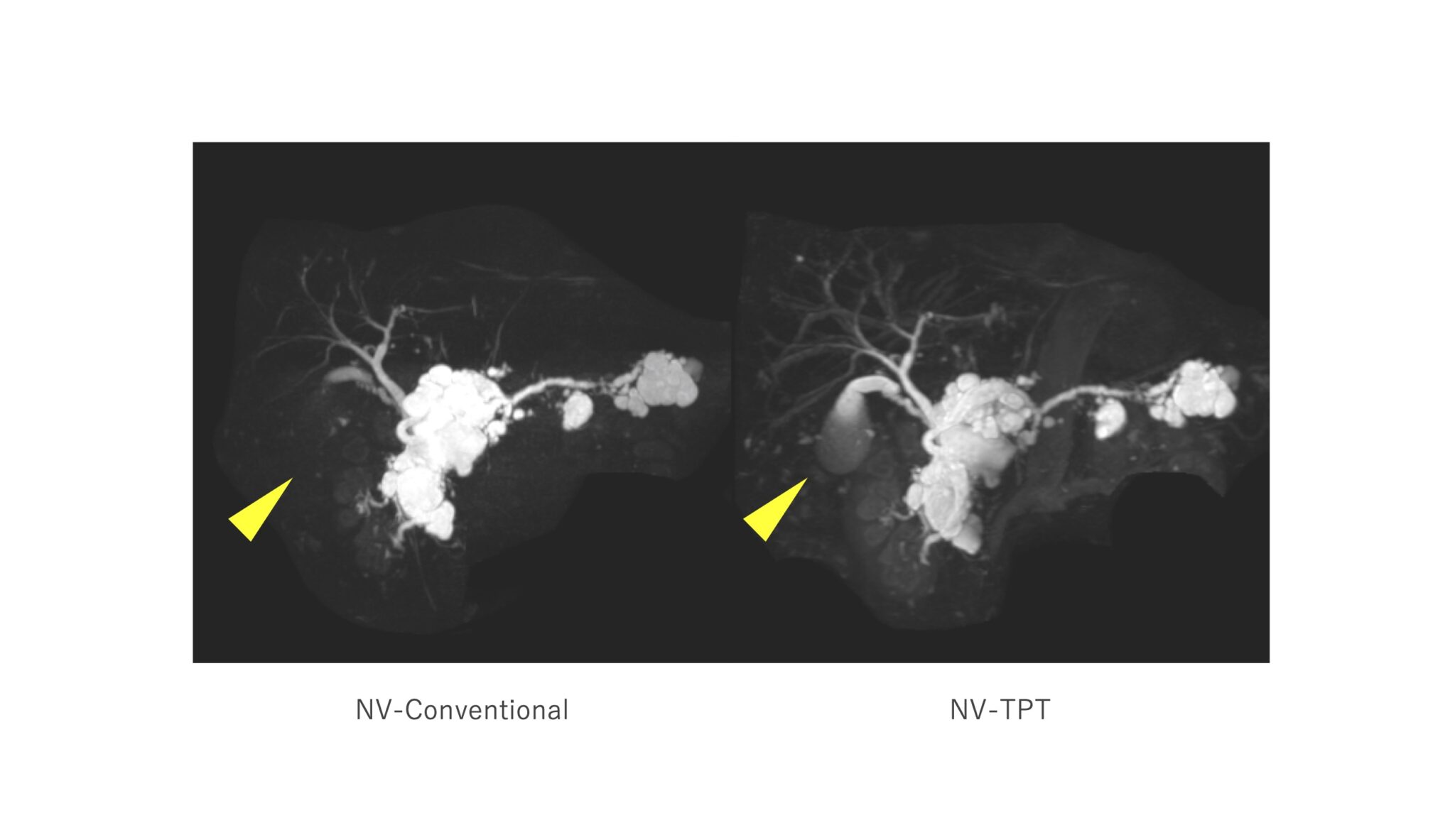 悩みを解消！TPT (T2 prep Pulse combined Turbo spin echo) MRCPの全貌 | MRIfan.net