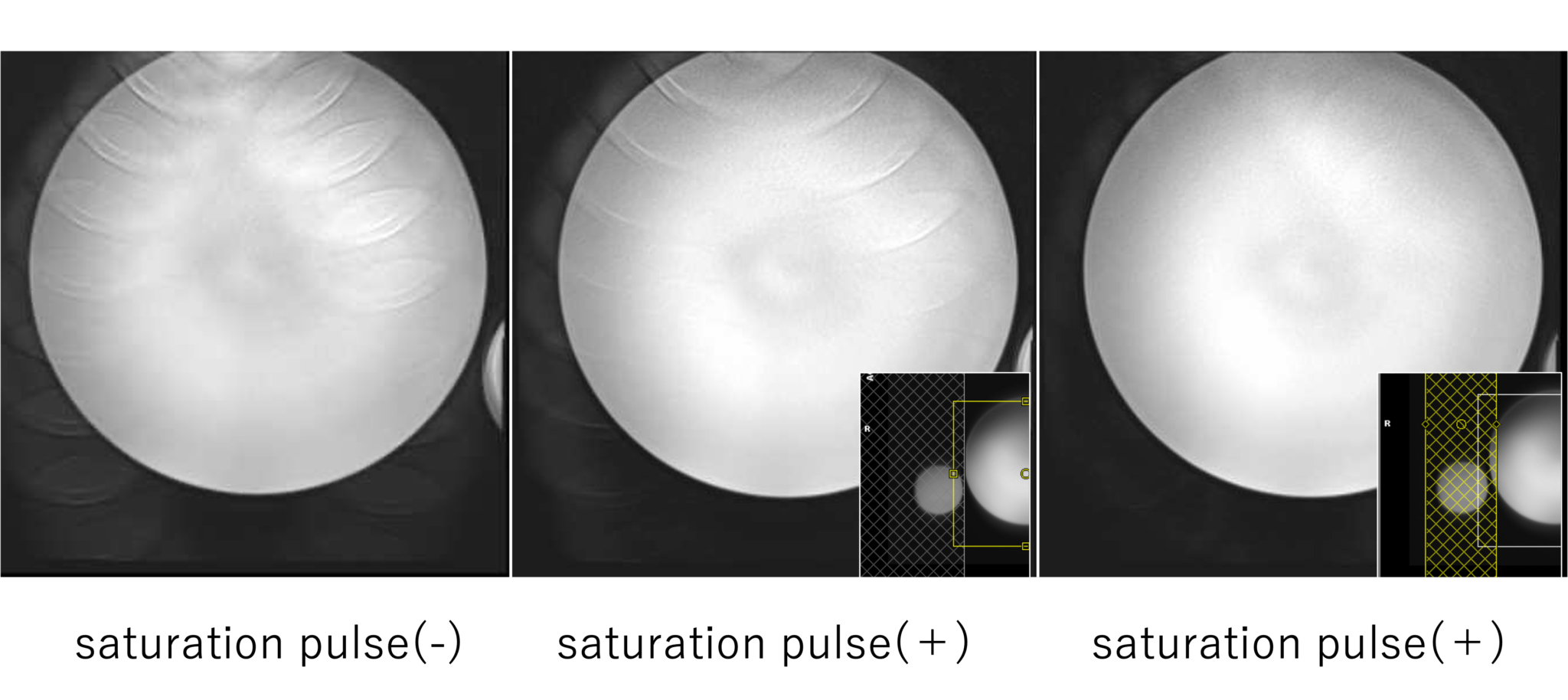 Radial scanについて少しだけ理解を深める | MRIfan.net